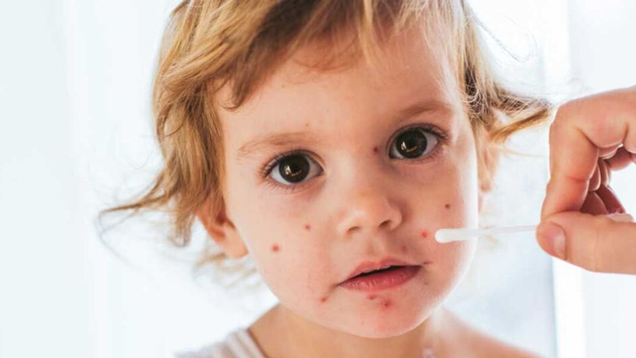 Çocuklarda su çiçeği hastalığı: Belirtiler, tedavi ve önlemler
